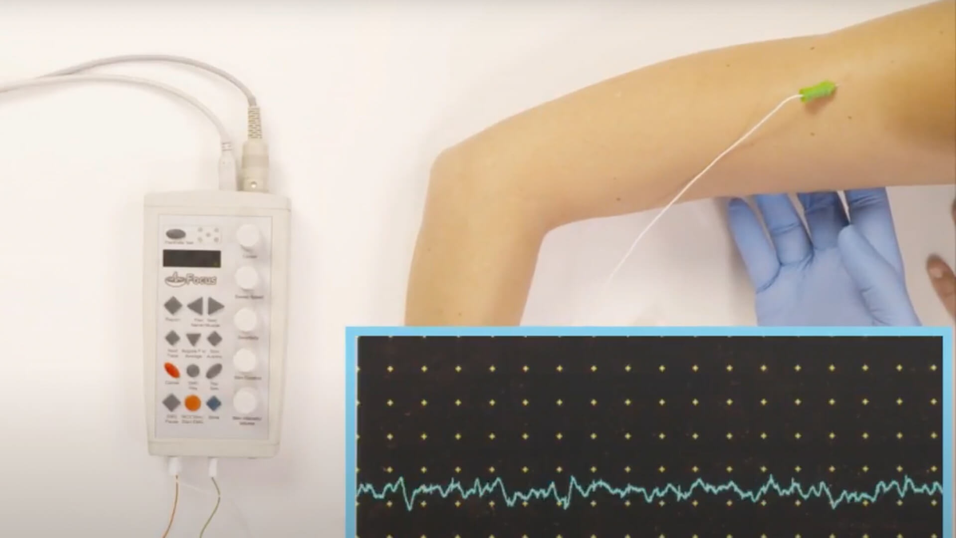 EMG Needle Exam - Tibialis Anterior (TA) - CloudEMG Videos - CloudNeuro