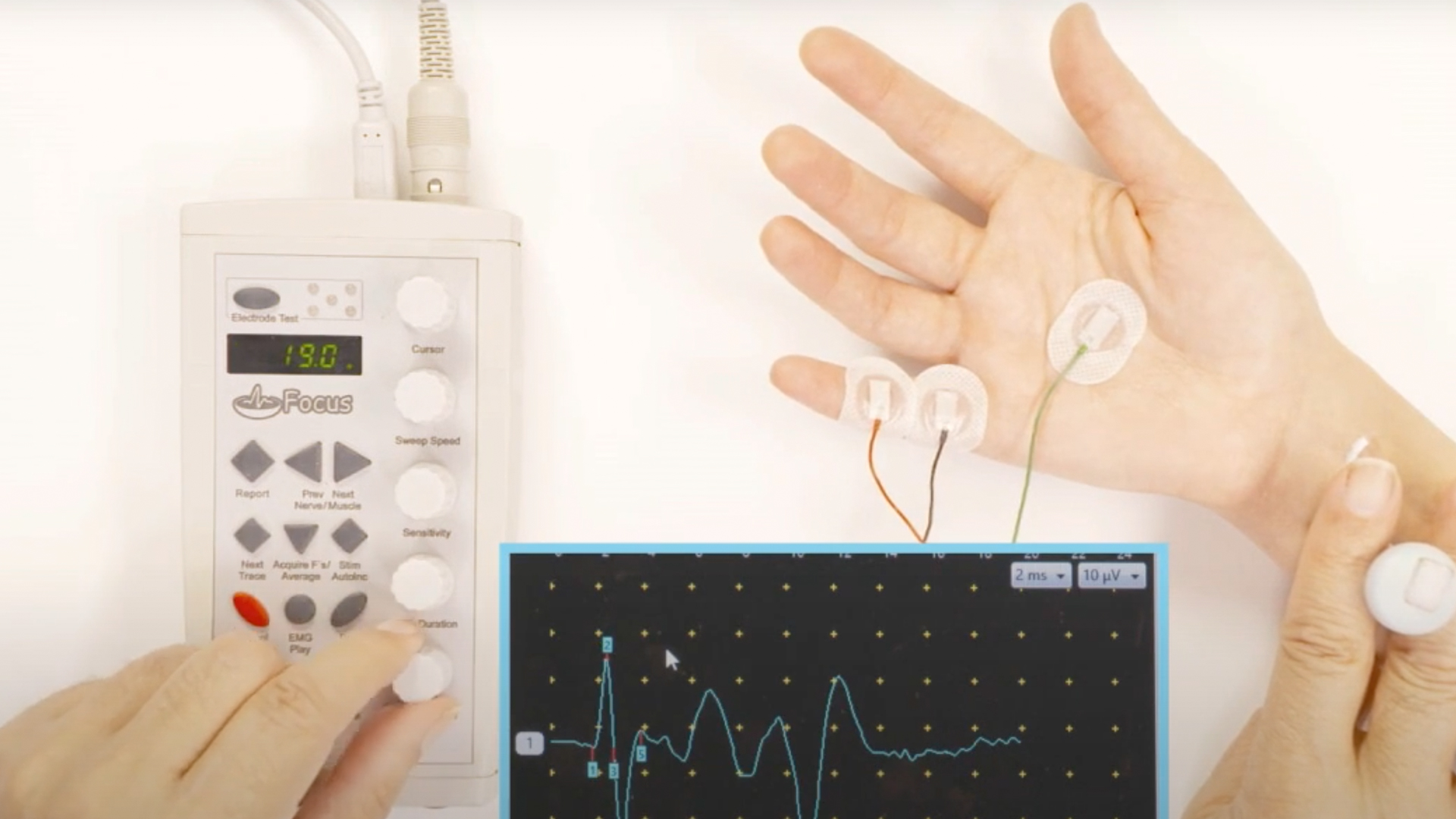 NCV Exam - Median Sensory - CloudEMG Videos - CloudNeuro
